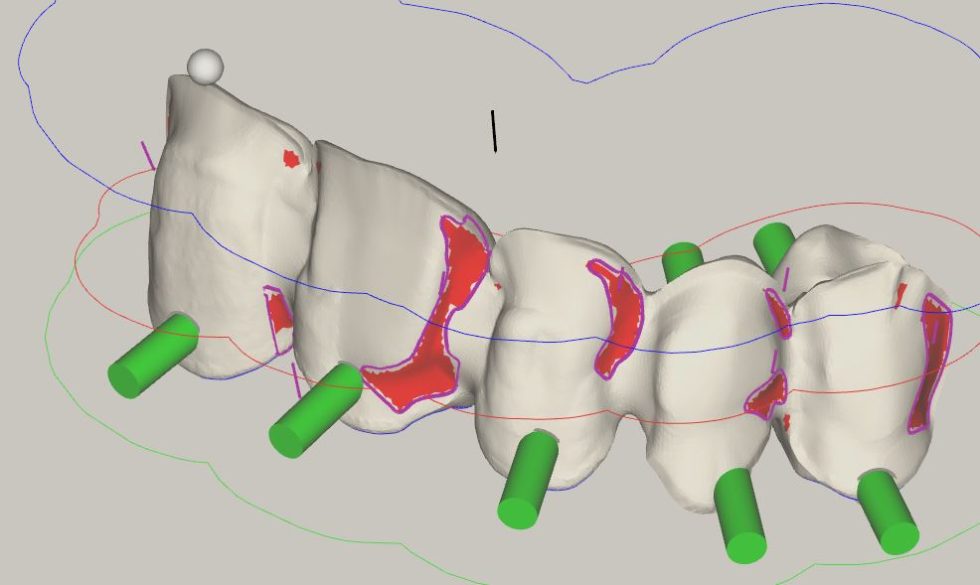 hyperDENT® V9.1 Release Highlights - FOLLOW-ME! Technology Group