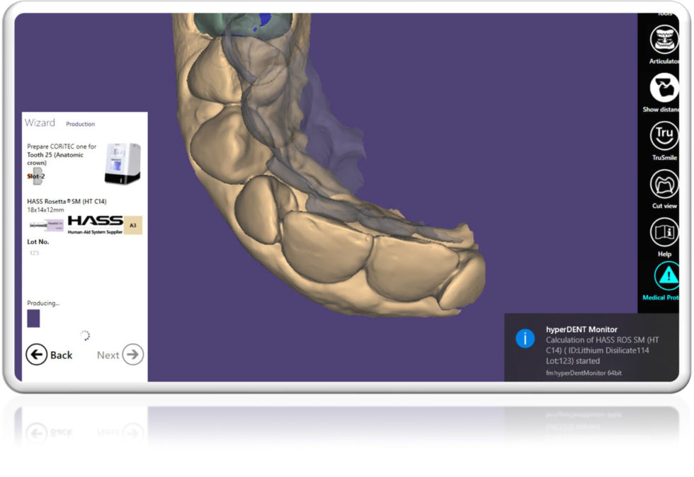 hyperDENT exocad Connect - FOLLOW-ME! Technology Group