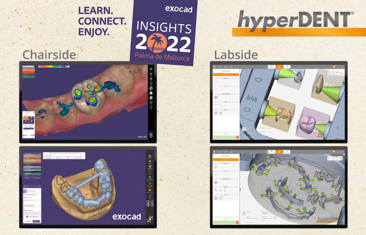 hyperDENT dental CAM software | FOLLOW-ME! Technology Group